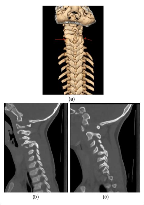 Bilateral Facet Dislocation