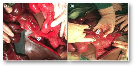 A B Short And Atrophied Ischemic Terminal Ileum That Indicated Right