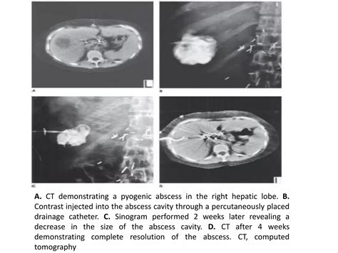 Liver Abscesspptx
