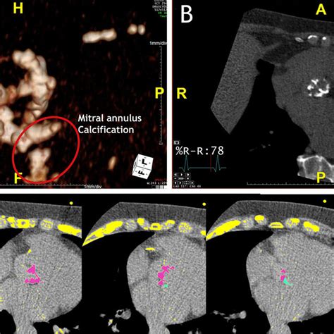 Ct Aortic Valve Calcium Measurement A The 3d Reconstruction Of The