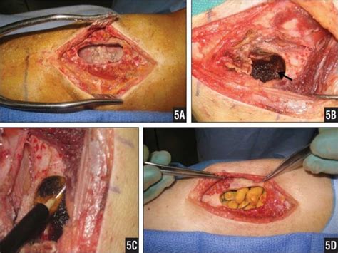 Osteomylitis Pptx Free Download