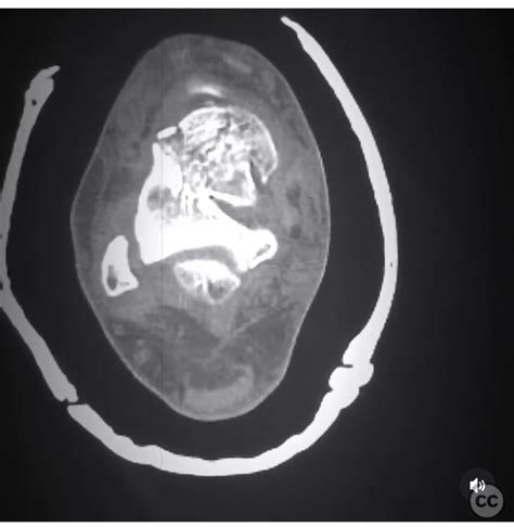 Bilateral Open Tibia Fractures With Comminuted Talar And Calcaneal