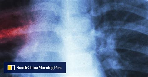 Girl Infected With Drug Resistant Tuberculosis Held In Quarantine At Hong Kong Hospital South