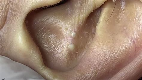 Remove Blackheads And Pimples Popping At Ht Spa 38