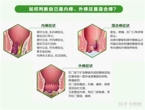 痔疮膏哪种好？ 知乎