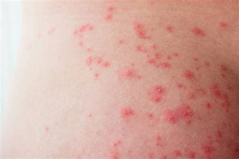 Menisko Plyšimas Priežastys Simptomai Gydymas Ir Profilaktika