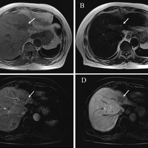 Magnetic Resonance Imaging Mri Findings Mri Showed A Lesion In The