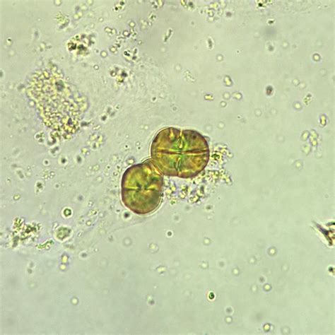 Leucine Crystals Identification And Clinical Significance