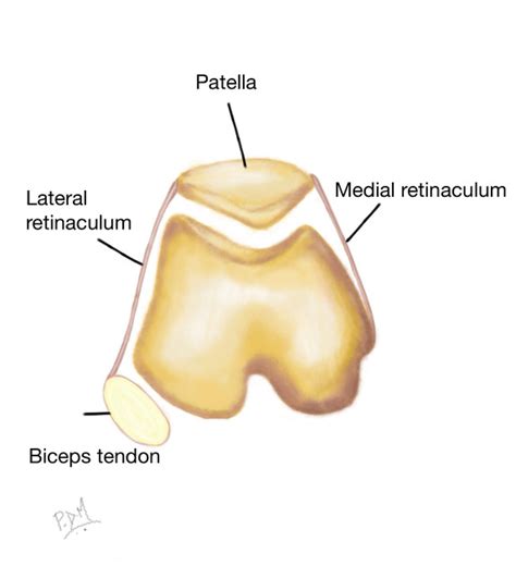 Lateral Patellar Dislocation Pacs