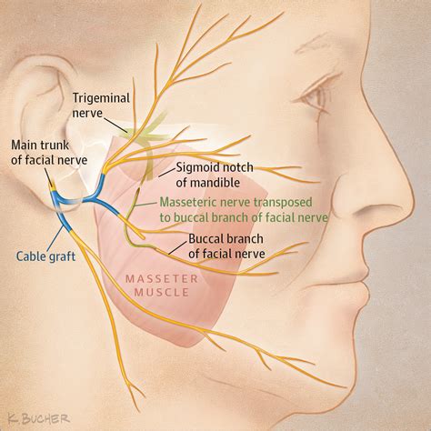 Facial Nerve Reconstruction With Concurrent Masseteric Nerve Transfer