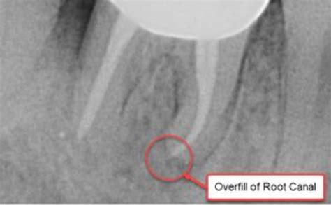 Failed Root Canal Infection At Paul Brower Blog