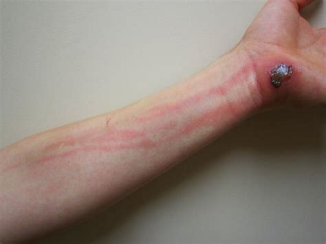 Lymphangitis Symptoms Causes Treatment And More