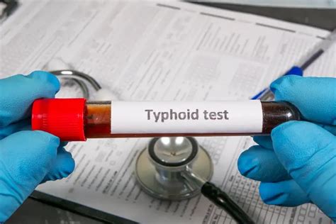 Typhoid Test Explained Procedure Timing And Side Effects