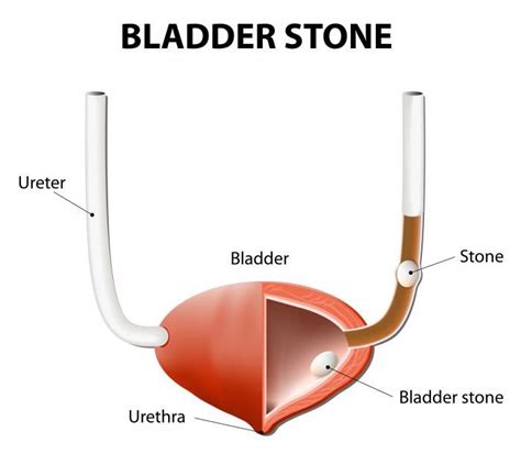 Bladder Stones Causes Symptoms And Treatments Artofit
