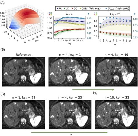 New Paper Reduction Of The Cardiac Pulsation Artifact And Improvement Of Lesion Conspicuity In