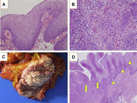 Progression Of Intravesical Condyloma Acuminata To Locally Advanced