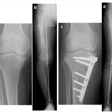 Staging Of Osteonecrosis Based On Planar Radiography And Magnetic