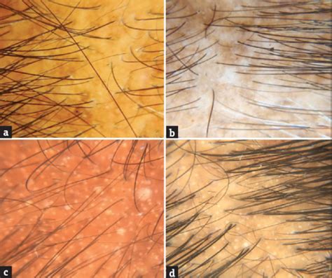 Correlation Of Trichoscopic Findings With Severity In Androgenetic Alopecia Pmc Correlation Of Trichoscopic Findings With Severity In Androgenetic Alopecia Pmc