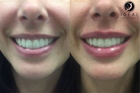 Ideal Lip Augmentation Of The Upper And Lower Lips With 8cc Of