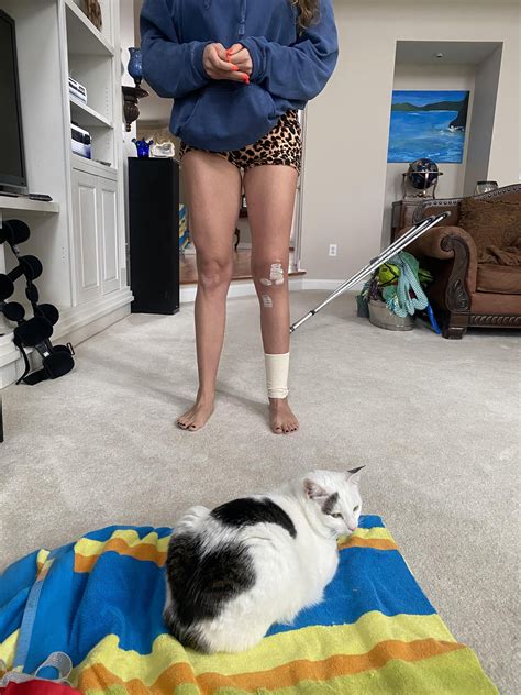 22 Days Post Op Atrophy R Acl