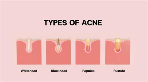 痤疮治疗一直反复？不如试试这么做 知乎