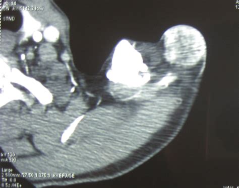 Angioscan Subcutaneous Hypervascular And Well Circumscribed Mass Of Download Scientific