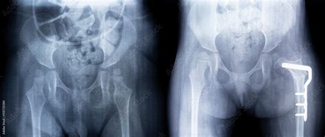 X Ray Before And After Surgery Femoral Osteotomy X Ray Film Of The Pelvis Dysplasia Of The