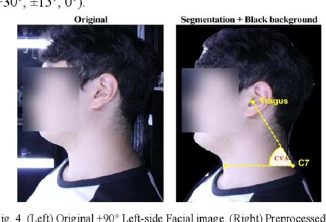 Figure 1 From Forward Head Posture Classification Using Deep Learning