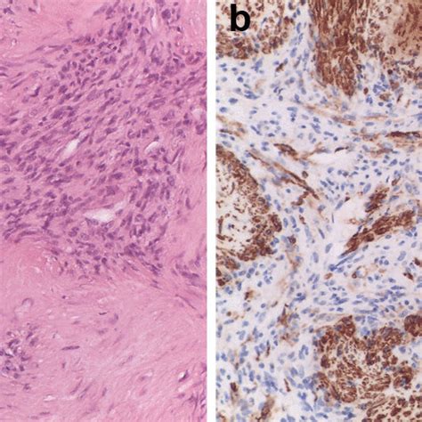 Case 2 A Note The Biphasic Pattern With The More Cellular Zone Showing Download Scientific