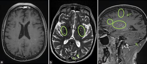 Intracranial Metastasis From Prostate Cancer Investigation Incidence