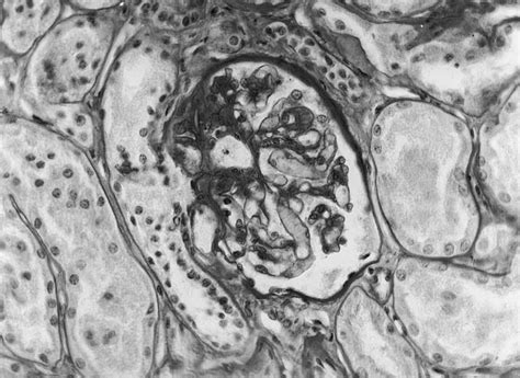 Photomicrography Of A Glomerulus With Segmental Sclerosis Pas ×100