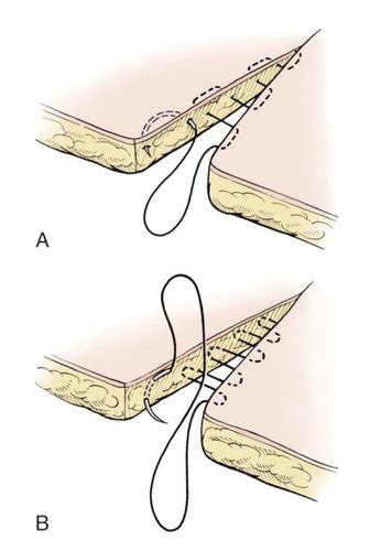 Lecture 4 Suture Materials And Patterns Flashcards Quizlet