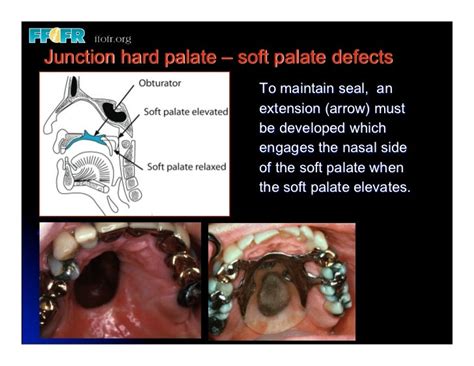 20 New Restoration Of Soft Palate Defects