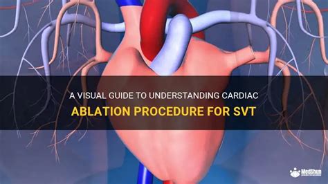 A Visual Guide To Understanding Cardiac Ablation Procedure For Svt