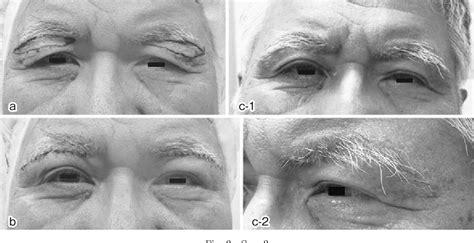 Figure 1 From Treatment Of Upper Eyelid Dermatochalasis By Resection Of