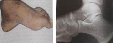 Perspective Chapter Podological Deformities And Its Management