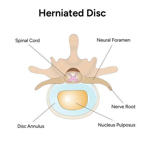 Premium Vector Herniated Disc In Vector