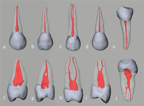 Drmoeintaghavi Vertuccis Classification For Root Canal Morphology