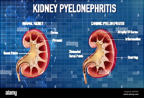 Informative Illustration Of Pyelonephritis Stock Vector Image And Art Alamy