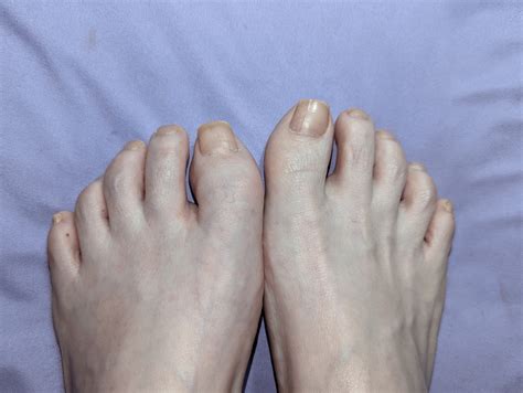 Left Big Toe But Also Toe Next To It R Footfunction