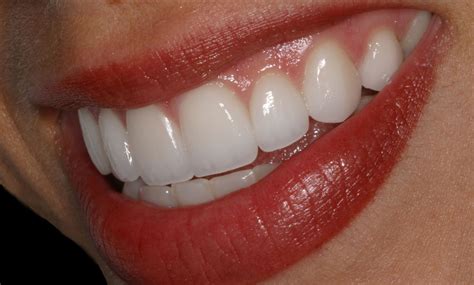 Smile By Dr David Hornbrook Ceramic Artistry By Gold Dust Aesthetic