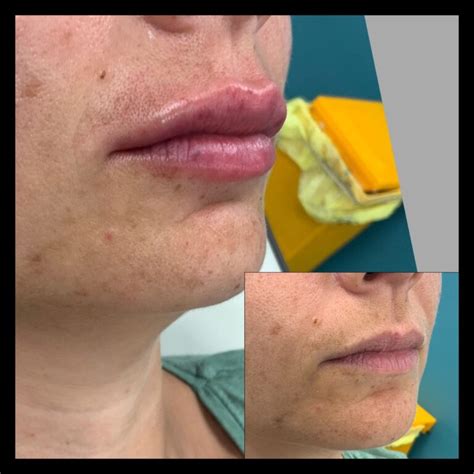 Lip Filler Swelling Stages A Complete Guide Myskyn Clinic
