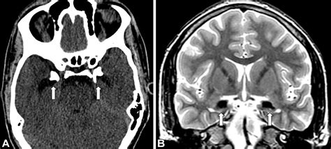 Imaging Aspects Of The Hippocampus Radiographics
