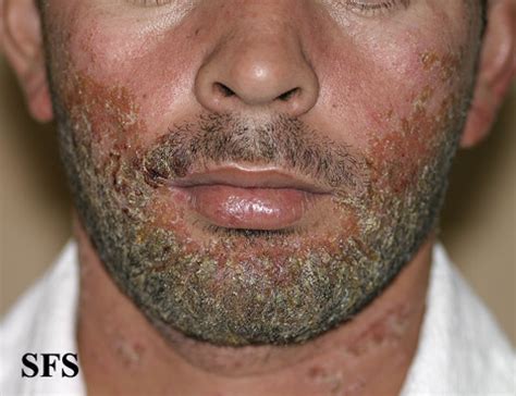 Sycosis Vulgaris Wikidoc