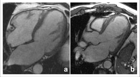Figure 1 From Total Surgical Plication Of Left Ventricular Aneurysm