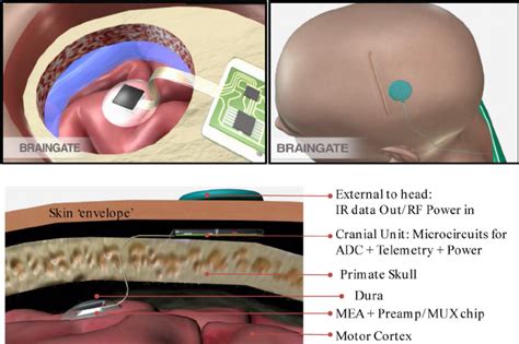 The Design Concept For A Fully Implantable Transcutaneous Wireless