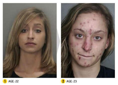 Harrowing Pictures Show The Devastating Effects Of Using Crystal Meth