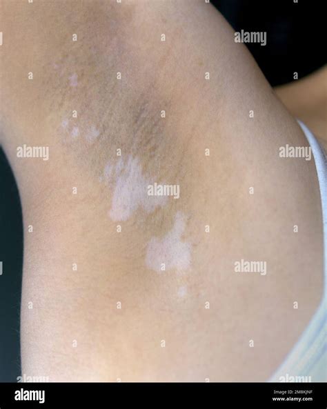 White Patches On The Arm At Stephanie Post Blog