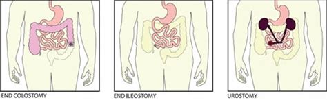 Colostomy Ileostomy And Urostomy