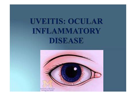 Solution Uveitis Ocular Inflammatory Disease Disorder Of The Eye